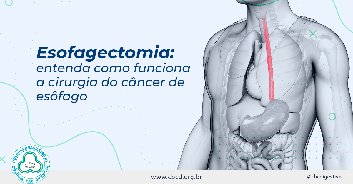 Esofagectomia: Entenda como funciona a cirurgia do câncer de esôfago – CBCD