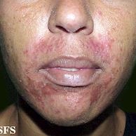 Dermatite Perioral - SBD