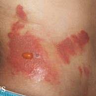 Fitofotodermatite - SBD