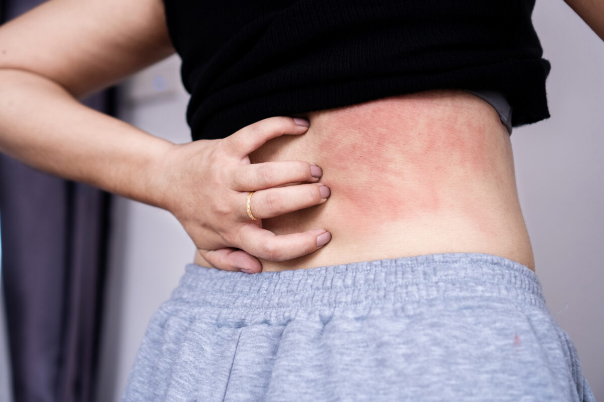 No mês da Dermatite Atópica, Sociedade Brasileira de Dermatologia ...